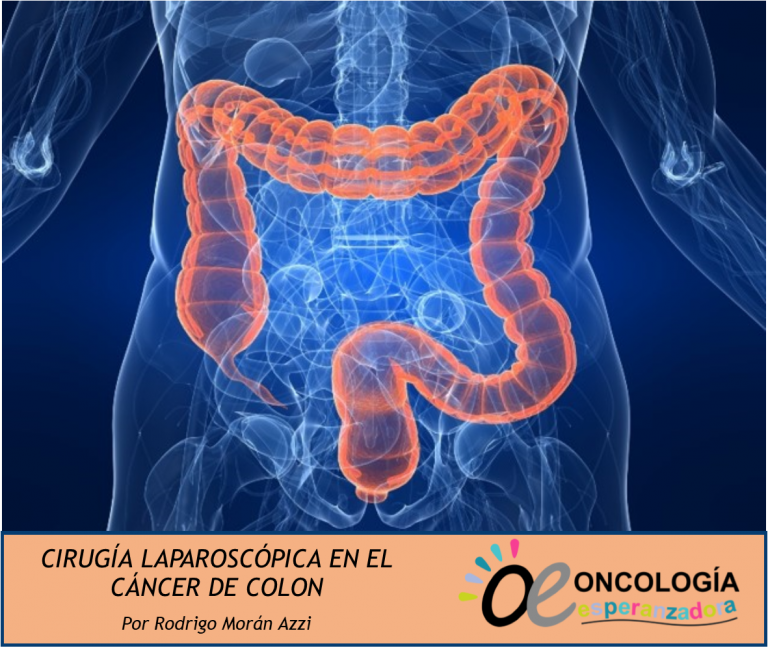 Cirugía laparoscópica en cáncer de colon | Oncología Esperanzadora
